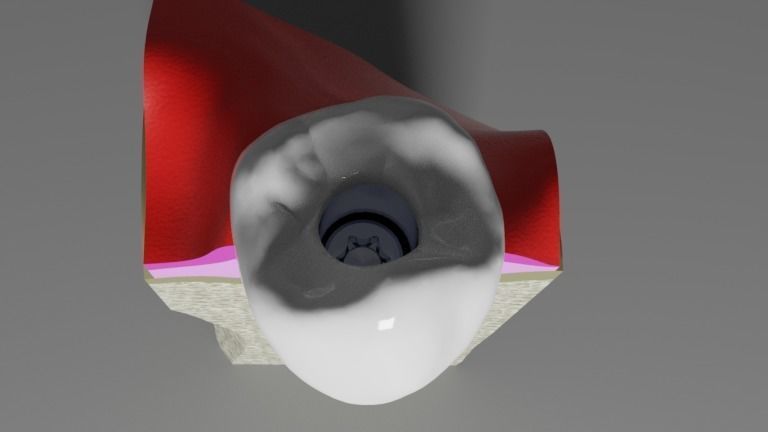 Peri-implant region - Anatomy 3D model | CGTrader