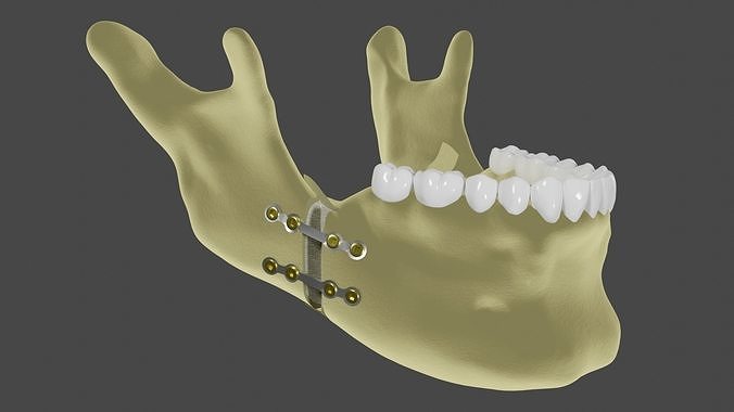 Orthognatic surgery - Titanium plates in the mandible 3D model | CGTrader