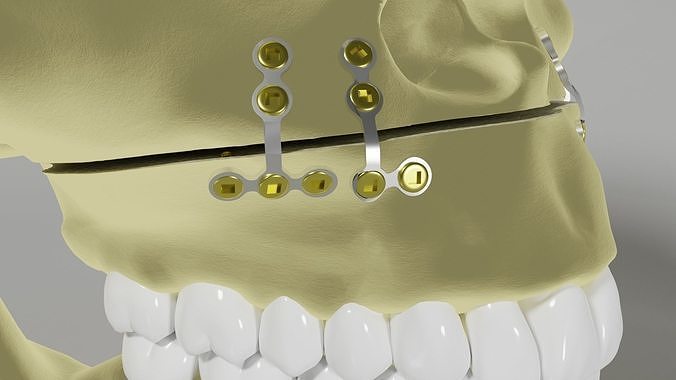 Orthognathic surgery - Titanium plates in the maxillae 3D model | CGTrader