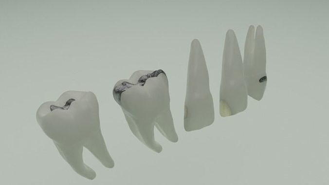 Dental restorations - Blacks Class I to V 3D model | CGTrader