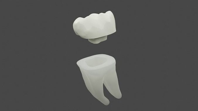 Endocrown restoration 3D model | CGTrader