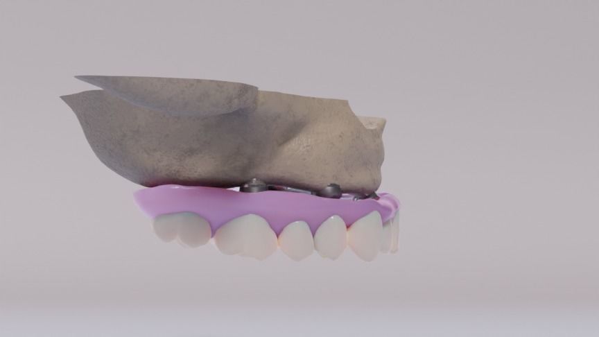 Full arch fixed implant-supported prostheses - Dental implant 3D model ...