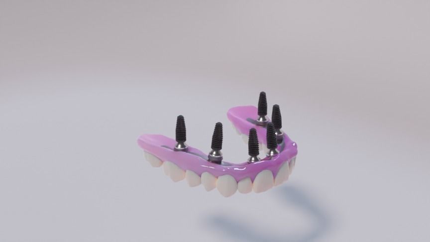 Full arch fixed implant-supported prostheses - Dental implant 3D model ...