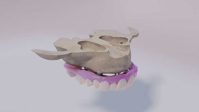Full arch fixed implant-supported prostheses - Dental implant 3D model ...