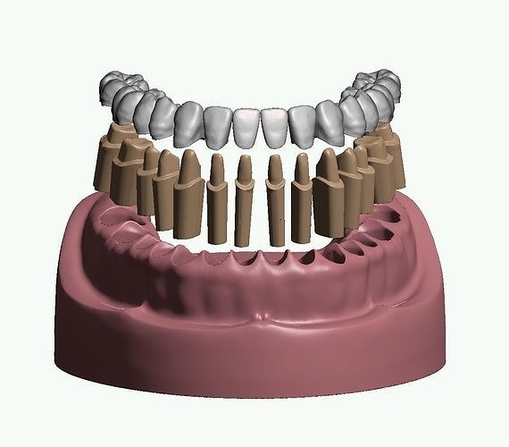 Mandibular dental model prepped dies and crowns 3D model 3D printable ...