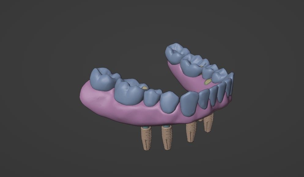 Full arch fixed implant-supported prostheses - Lower arch 3D model ...