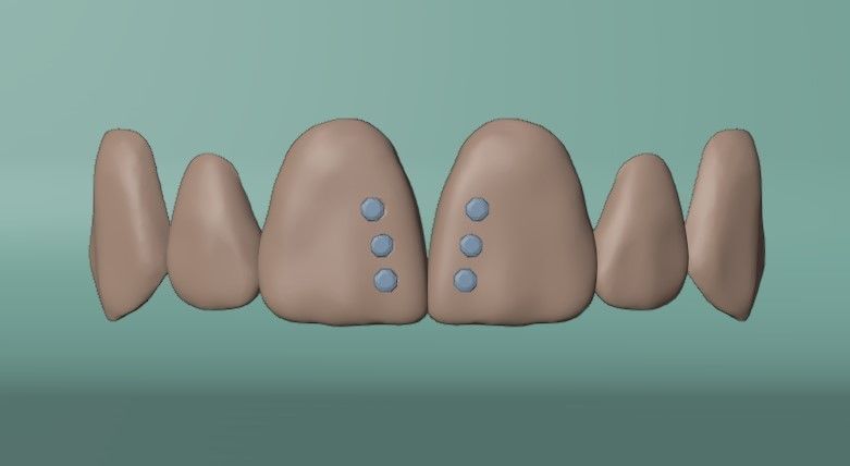 Grillz with diamonds in the front teeth 3D model | CGTrader