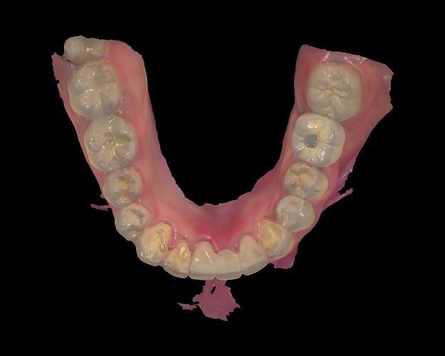 dental inlay model 3D model 3D printable | CGTrader