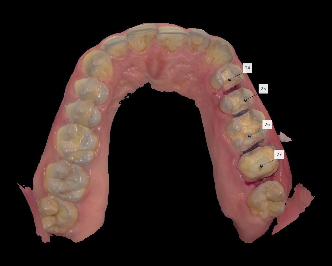 dental inlay model 3D model 3D printable | CGTrader