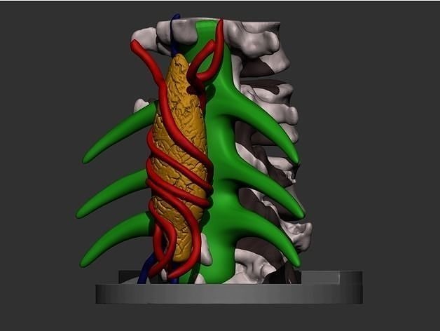 FAMOUS GREYS ANATOMY TUMOR 3D model 3D printable | CGTrader