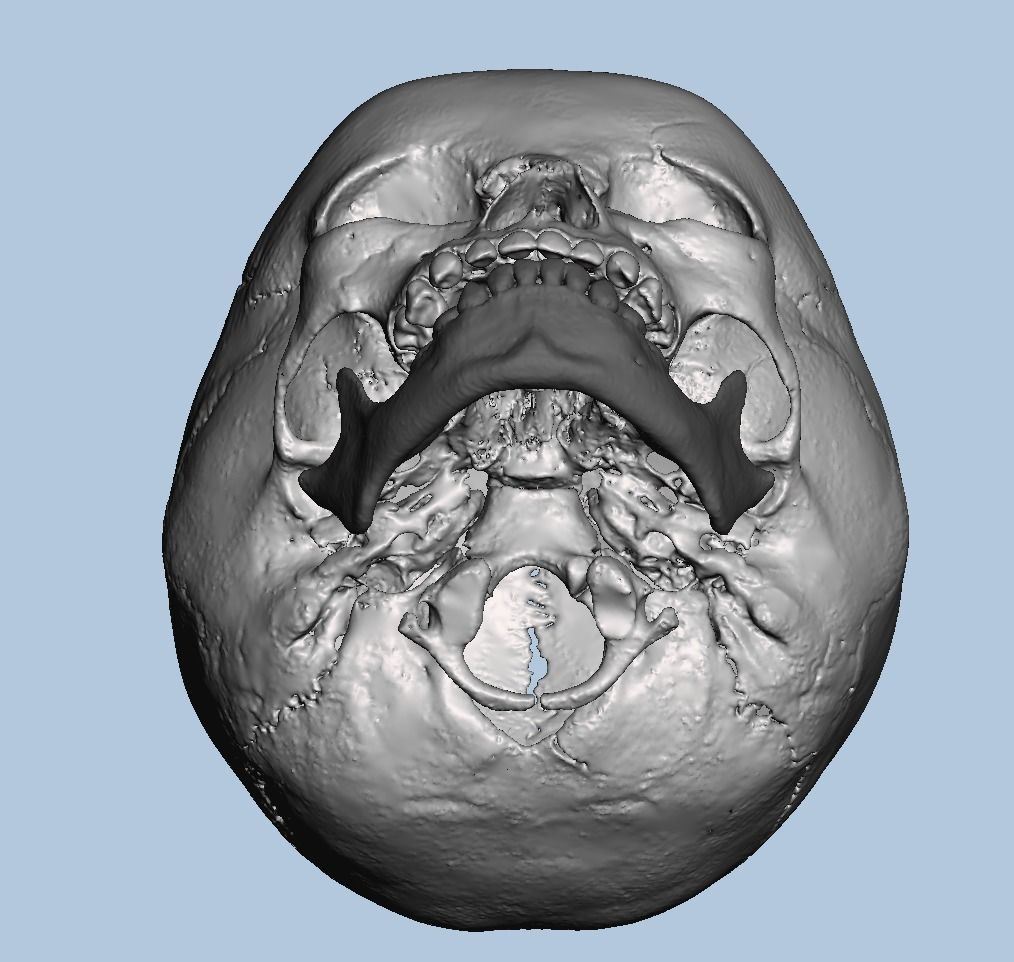 3D skull model converted from DICOM data 3D model 3D printable | CGTrader