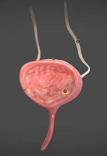 3D model Bladder cancer VR / AR / low-poly | CGTrader
