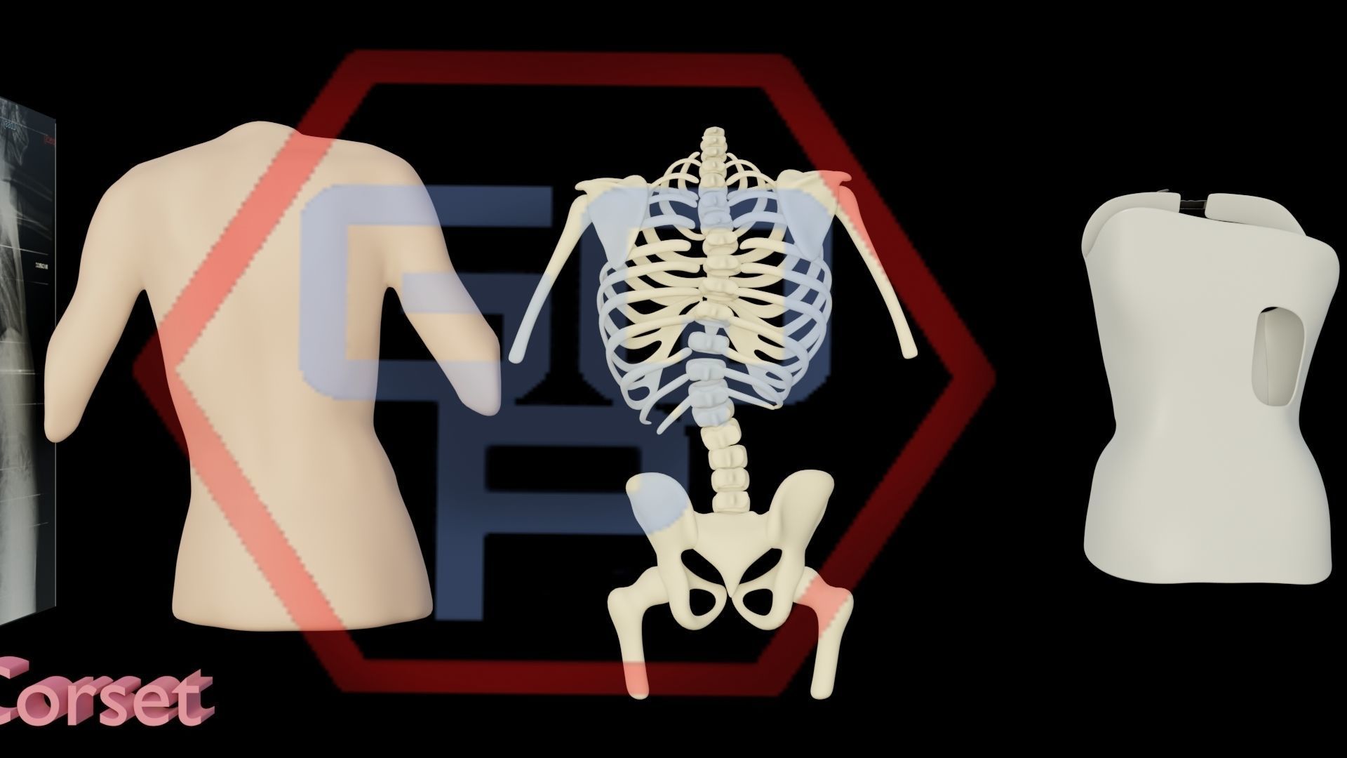 3D model Orthopedic brace corset scoliosis animation VR / AR / low-poly ...
