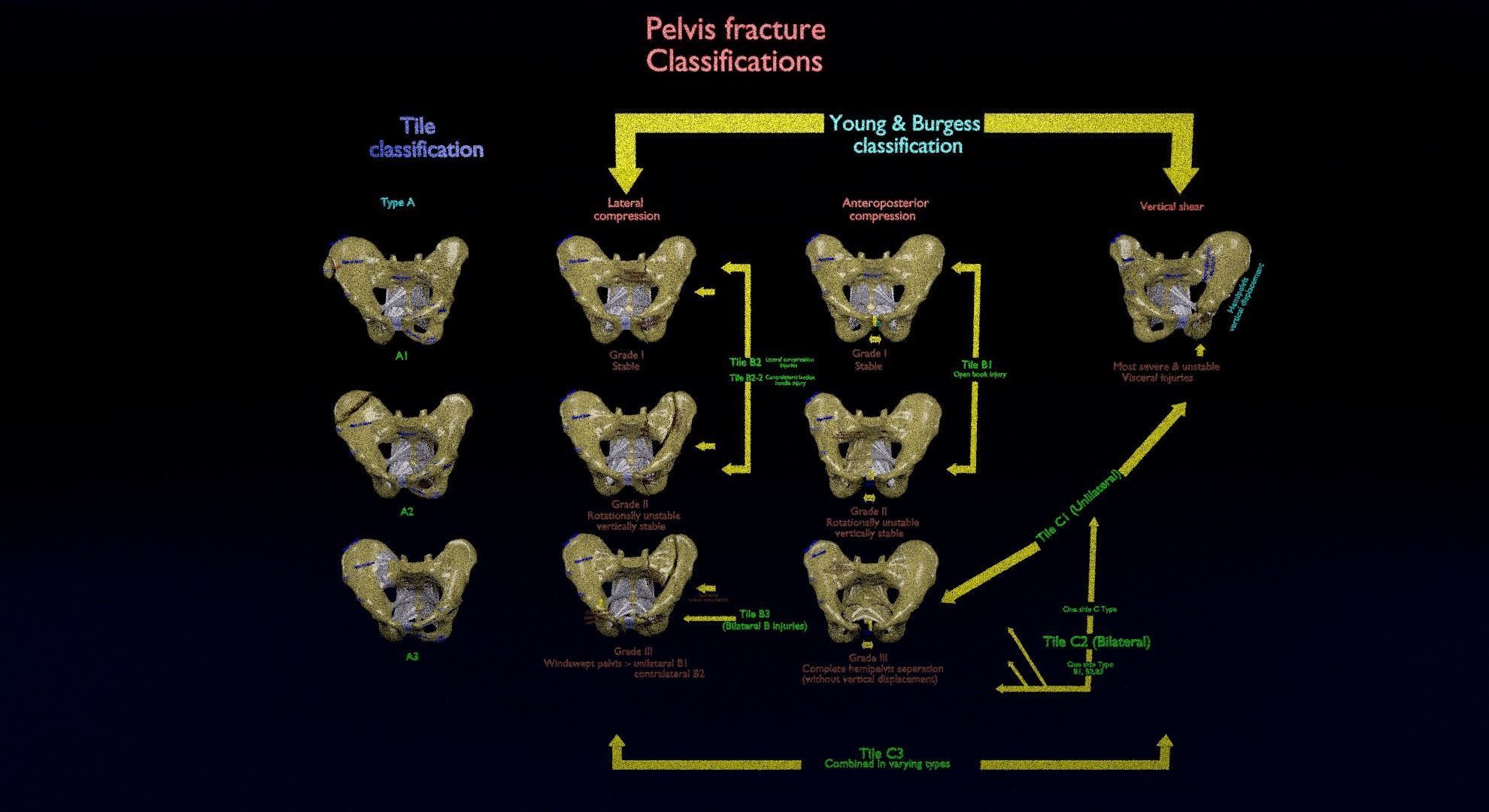 Pelvis fracture classifications 3D model | CGTrader