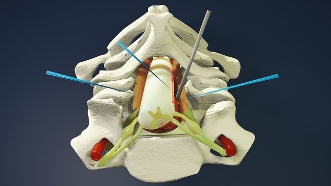 spinal intradural tumor with ventral attachment 3D model | CGTrader