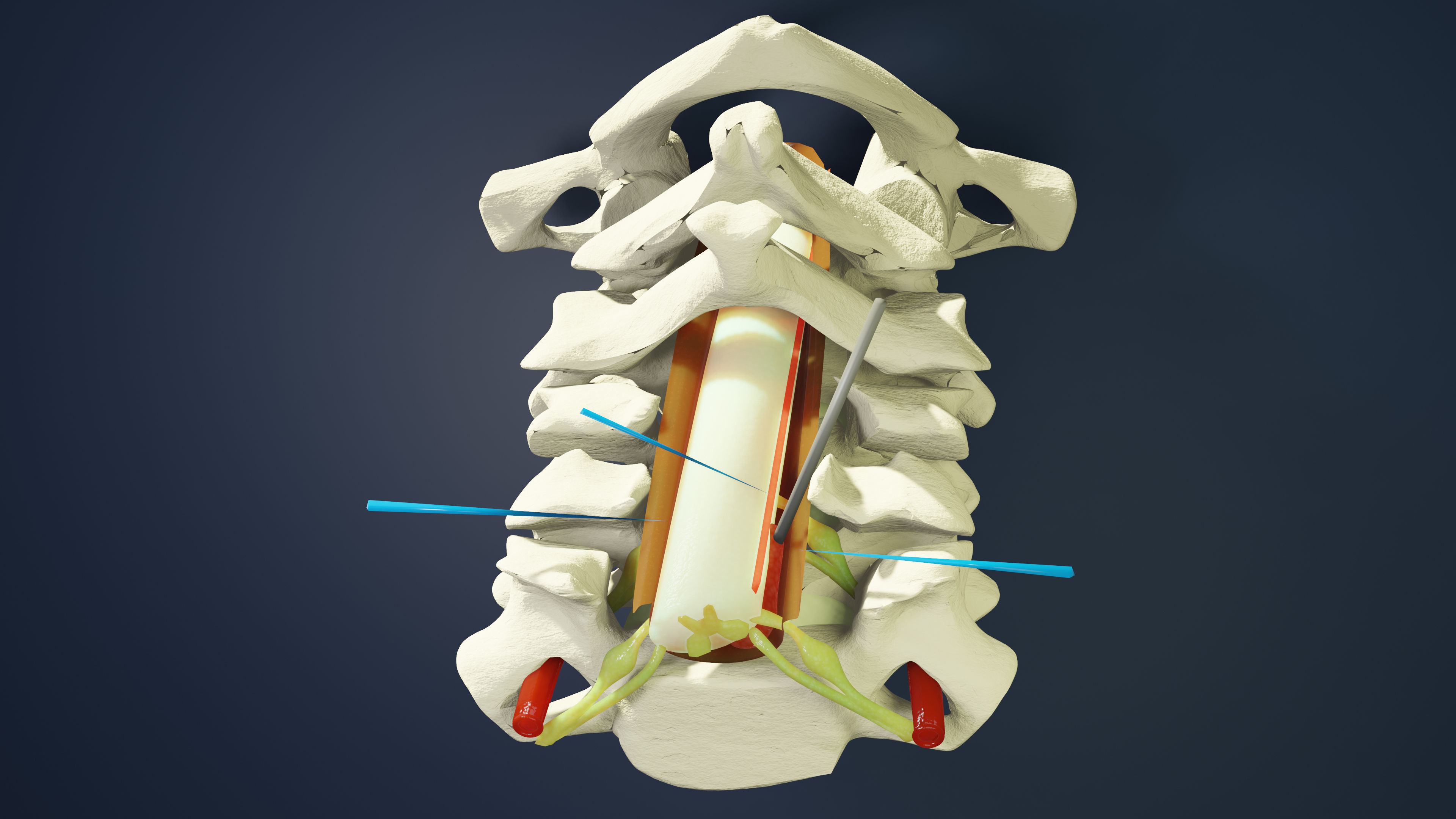 spinal intradural tumor with ventral attachment 3D model | CGTrader