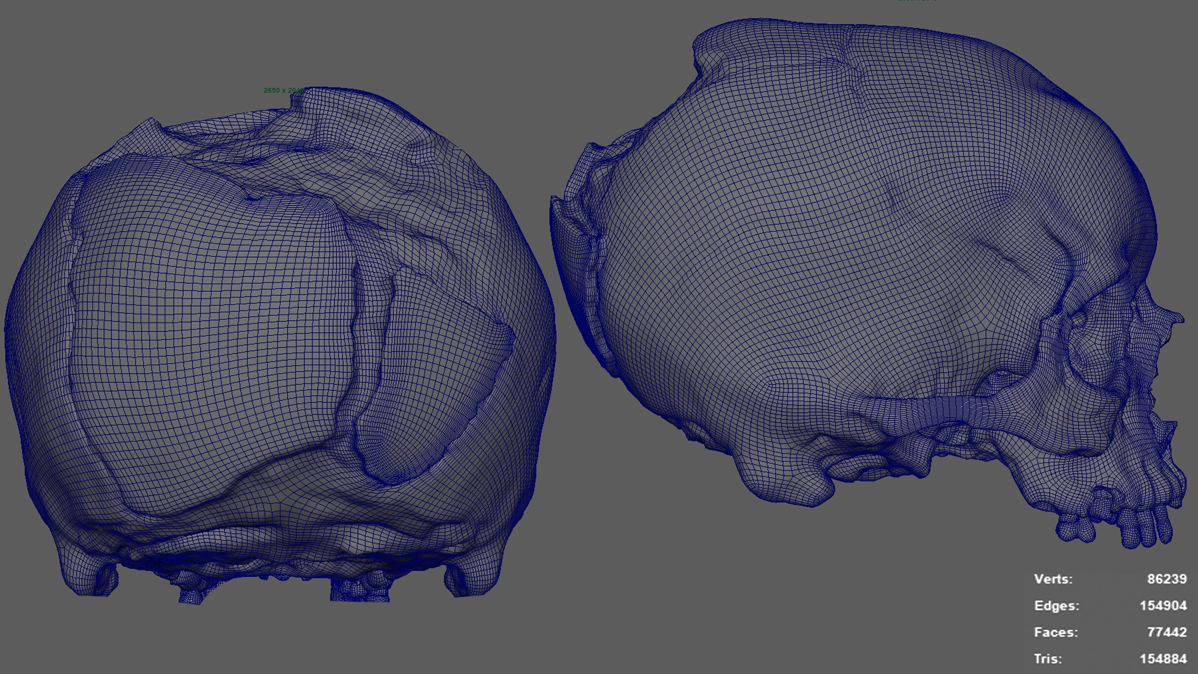 Photorealistic Skull with parietal trauma 3D model | CGTrader