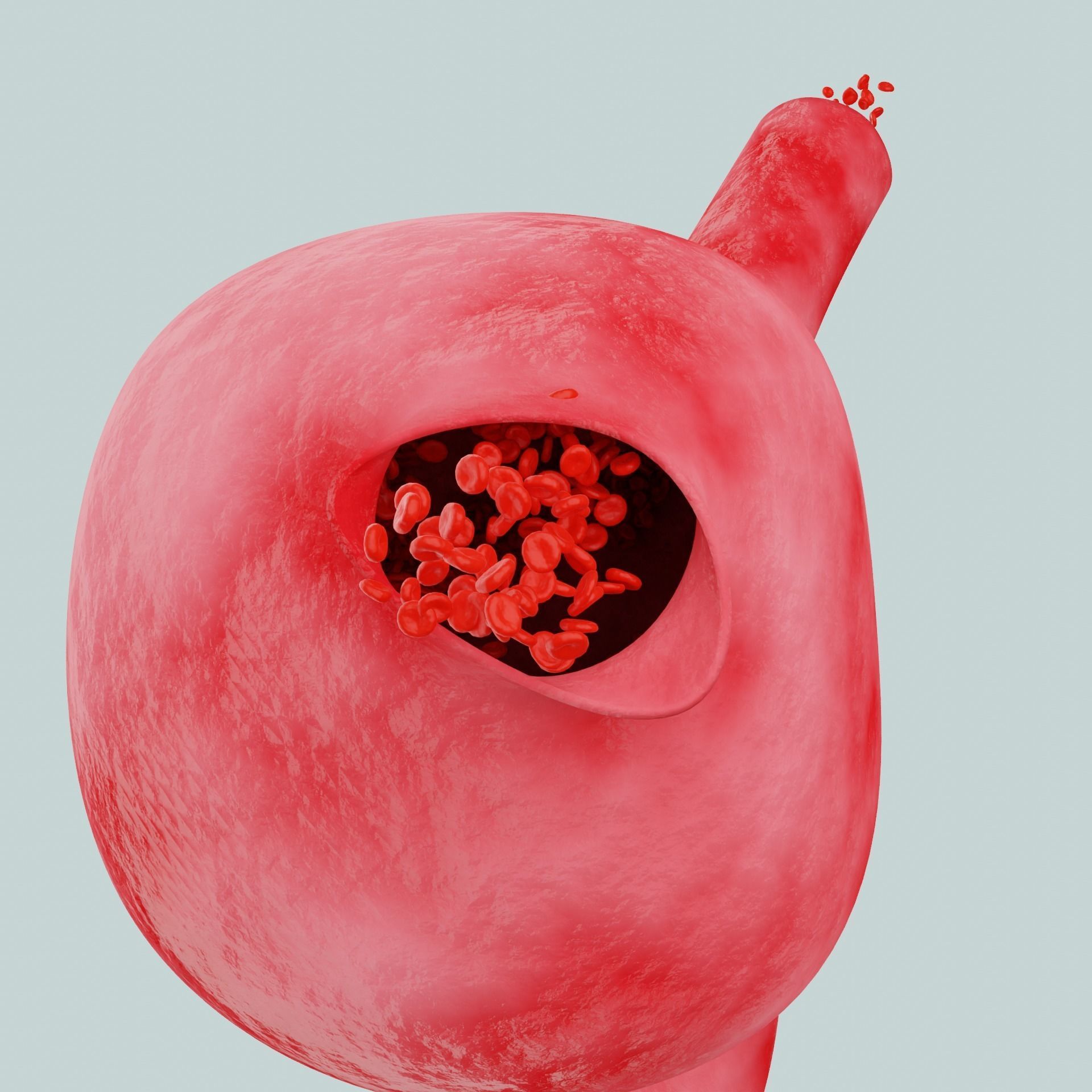 3D model Aneurysm ruptured photorealistic animated VR / AR / low-poly ...