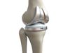 Knee Replacement Implant 3D model | CGTrader