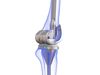 Knee Replacement Implant 3D model | CGTrader