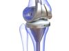 Knee Replacement Implant 3D model | CGTrader