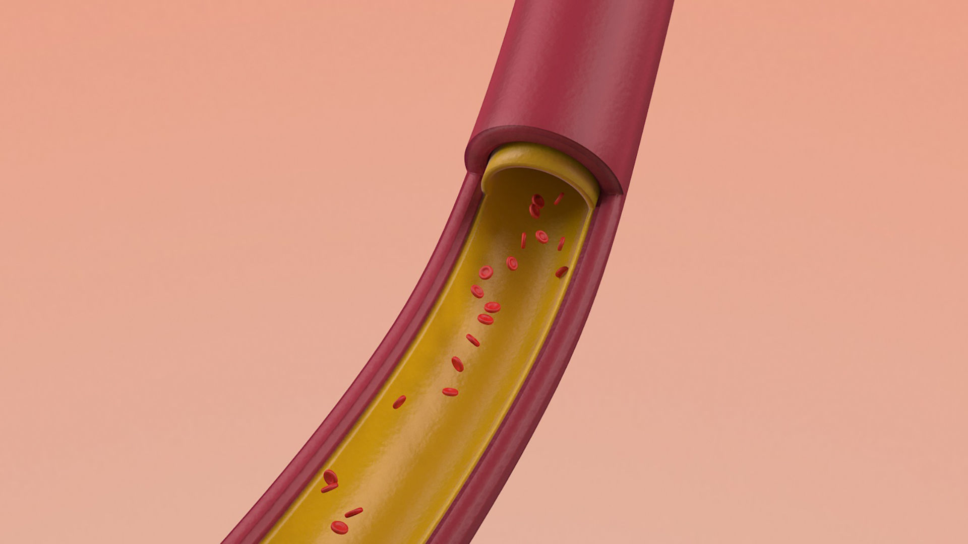 Artery Vein Clog Clot Clogged Stream Bloodflow Layers Section 3D model ...