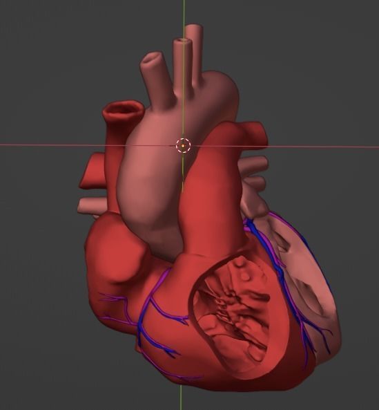 3d model of heart with atrial septal defect 3D model | CGTrader