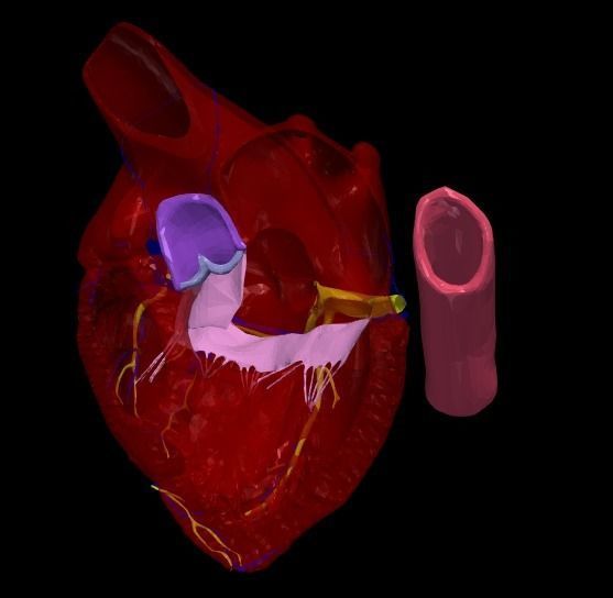 3d model of heart with atrioventricular septal defect 4 chamber 3D ...