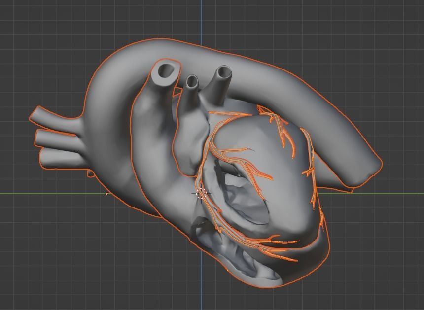 3d model of heart with atrial septal defect 3D model 3D printable ...
