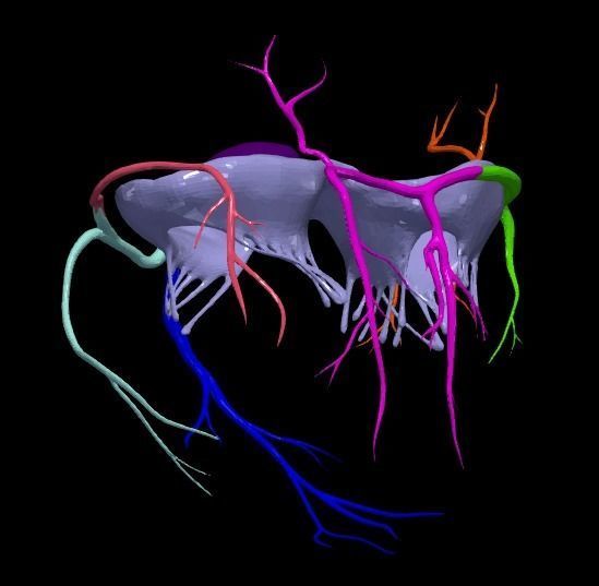 3d model of heart with bicuspid aortic valve 3D model 3D printable ...