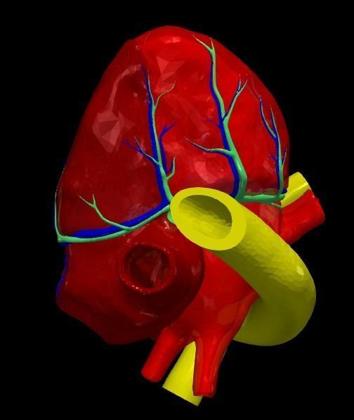 3d model of heart with common arterial trunk 3D model 3D printable ...