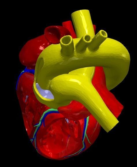 3d model of heart with common arterial trunk 3D model 3D printable ...