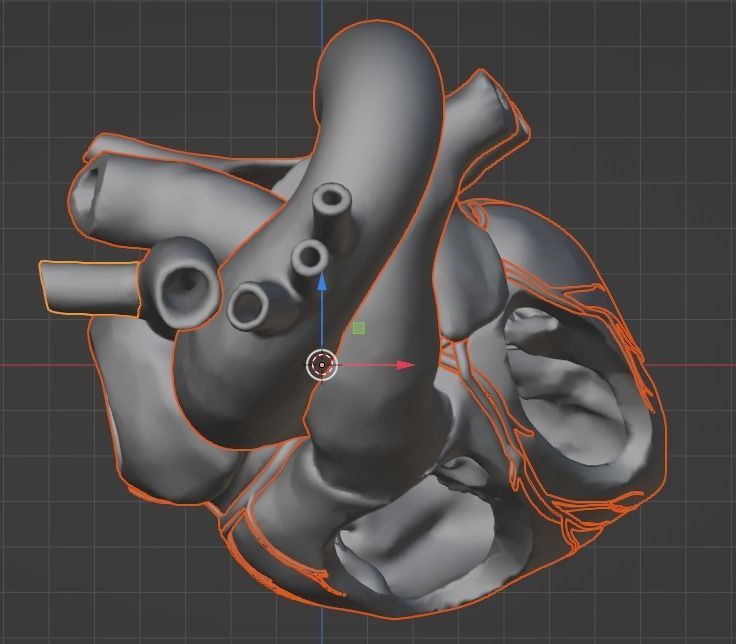 3d model of heart with PAPVC 3D model 3D printable | CGTrader
