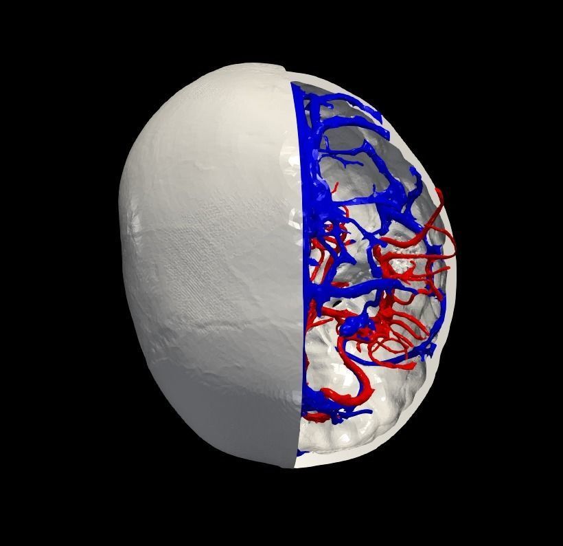 3D Model of Brain Arteriovenous Malformation 3D model 3D printable ...