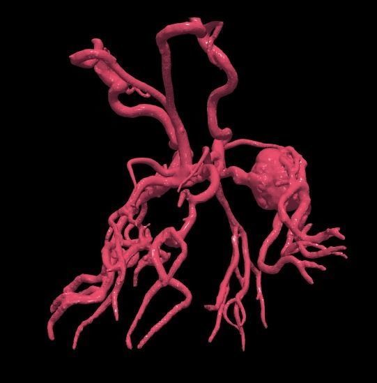 3D Model of Middle Cerebral Artery Aneurysm 3D model 3D printable ...