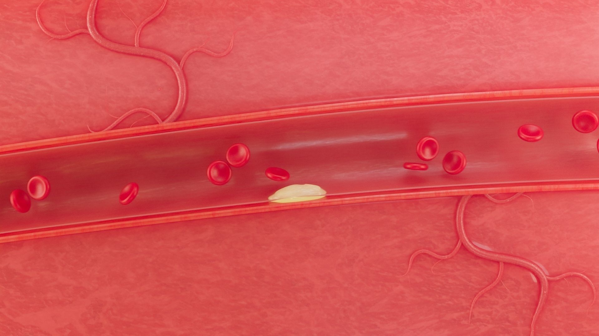 Blood Vascular blockage 3D model animated | CGTrader