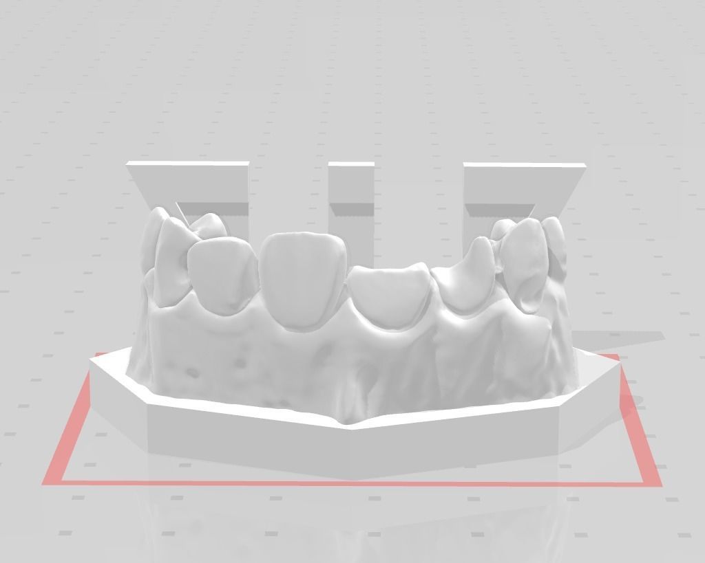 Segmented Anterior Class 5 Class III Class IV Direct Veneer 3D model 3D ...