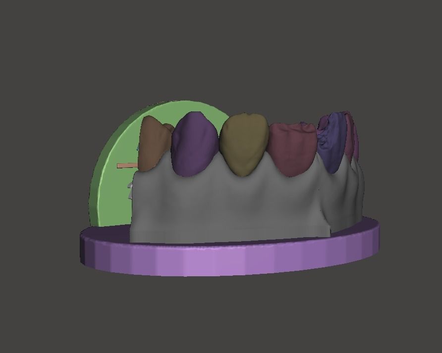 Segmented Anterior Class IV and Class VI by EDM DENTAL PRACTICE 3D ...
