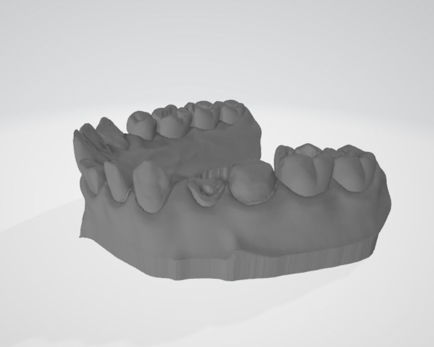 Segmented Full Mixed Arch Complex Cases by EDM DENTAL PRACTICE 3D model ...