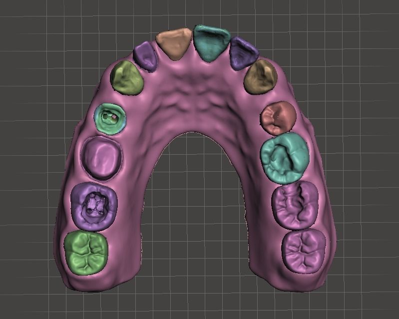 Segmented Full Mixed Arch Complex Cases by EDM DENTAL PRACTICE 3D model ...