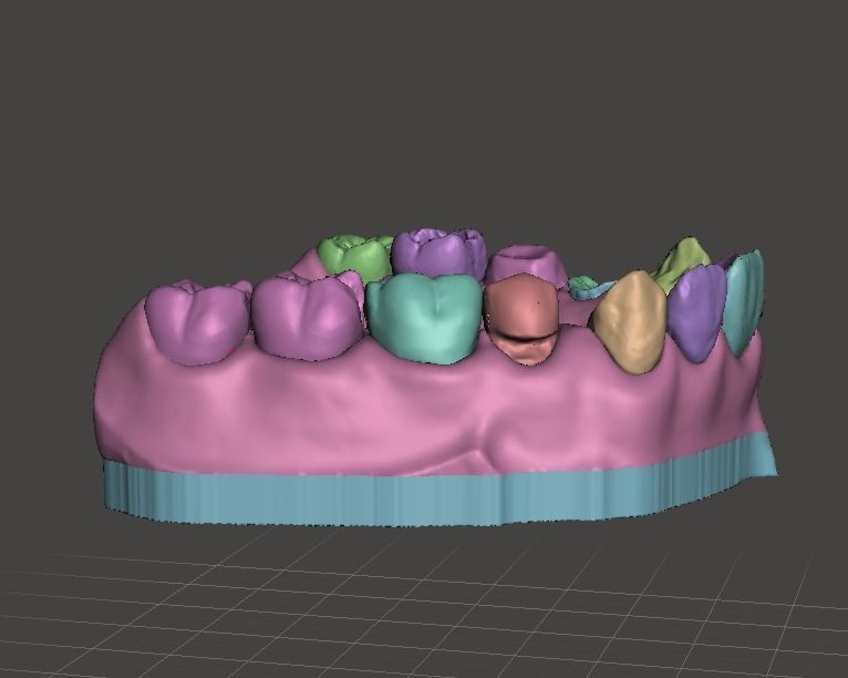 Segmented Full Mixed Arch Complex Cases by EDM DENTAL PRACTICE 3D model ...