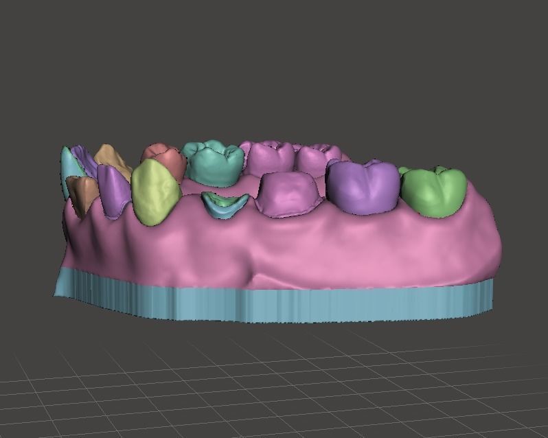Segmented Full Mixed Arch Complex Cases by EDM DENTAL PRACTICE 3D model ...