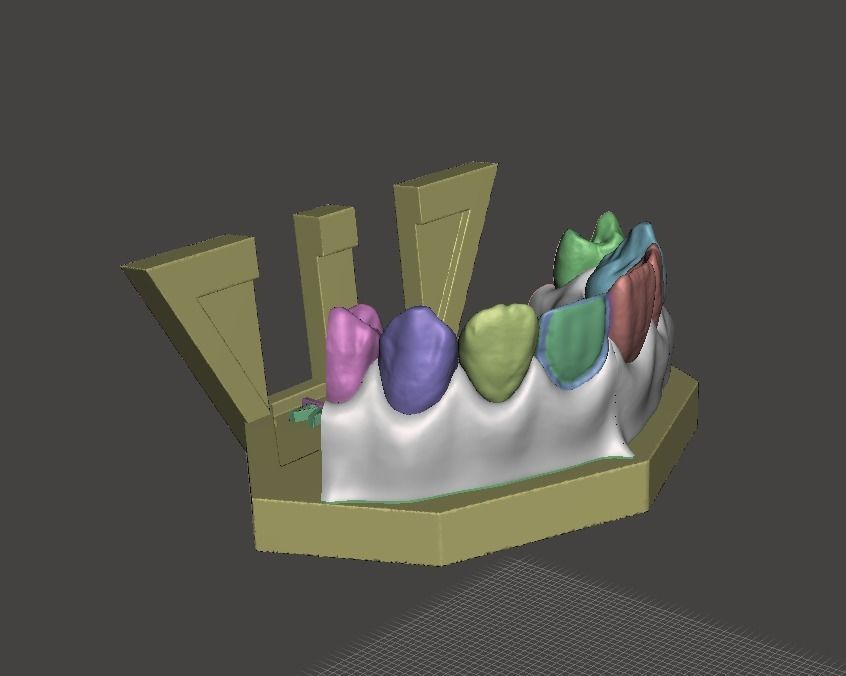 Segmented Anterior Direct Veneer by EDM DENTAL PRACTICE 3D model 3D ...