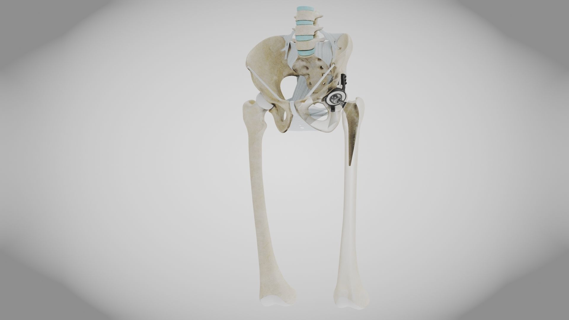 3D model Replaced Pelvic Implant VR / AR / low-poly | CGTrader