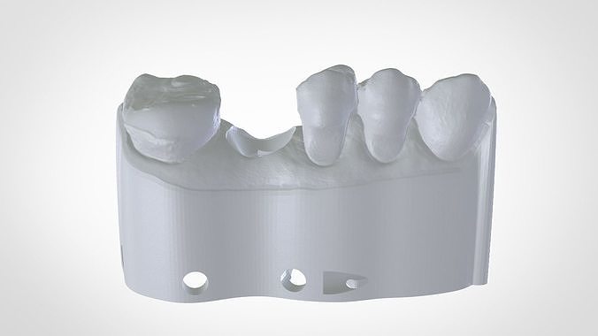 Digital Implant Model with a Metal Analog for 3D model 3D printable ...