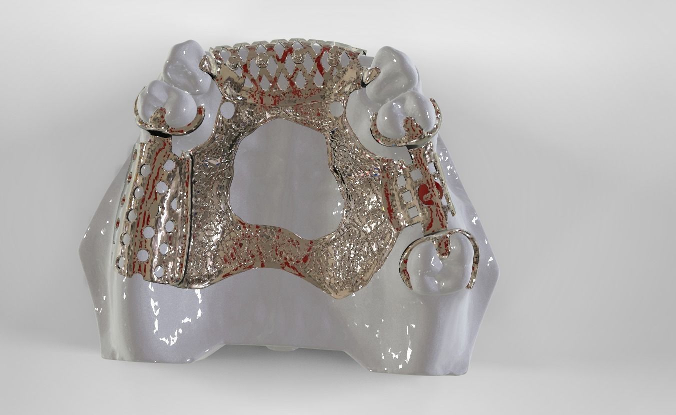 Digital Removable Partial Denture Framework 3D model 3D printable ...