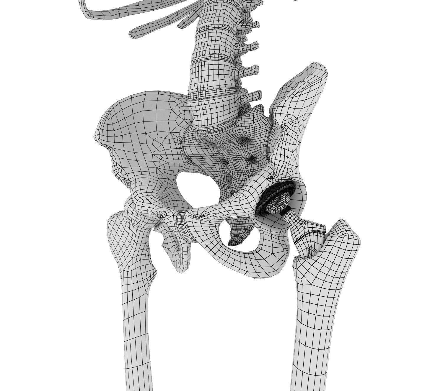 Hip replacement implant installed in the pelvis bone 3D model | CGTrader
