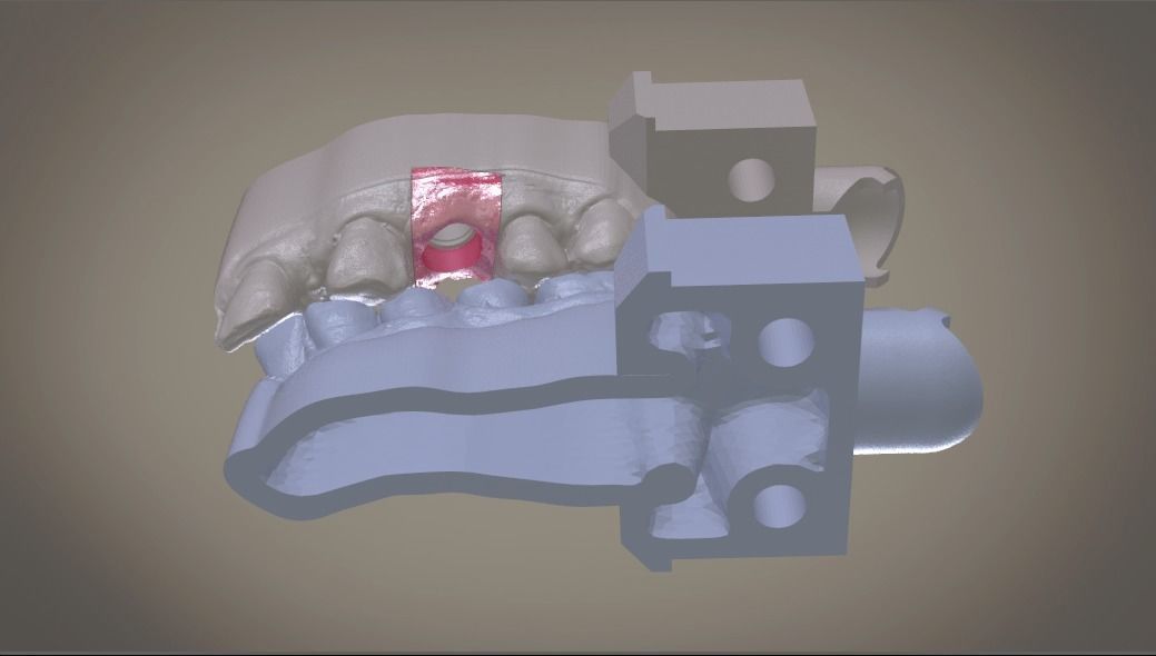 Digital Implant Model with Soft Tissue 3D model 3D printable | CGTrader