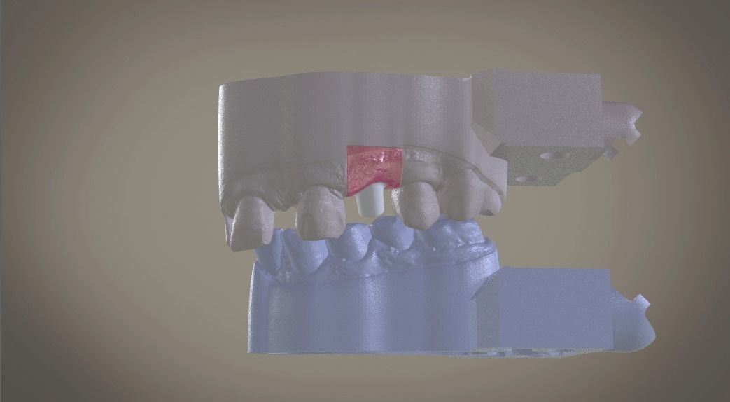 Digital Implant Model with Soft Tissue 3D model 3D printable | CGTrader