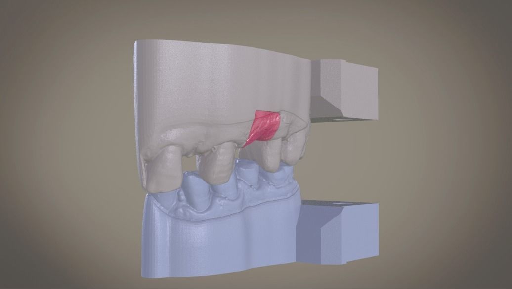 Digital Implant Model with Soft Tissue 3D model 3D printable | CGTrader